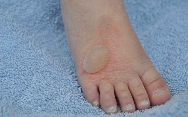 Treating Cuts in the Kitchen - Quick and Safe!