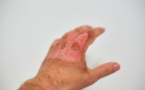 Kitchen First Aid Tips: Burn Treatment (Updated for 2024)
