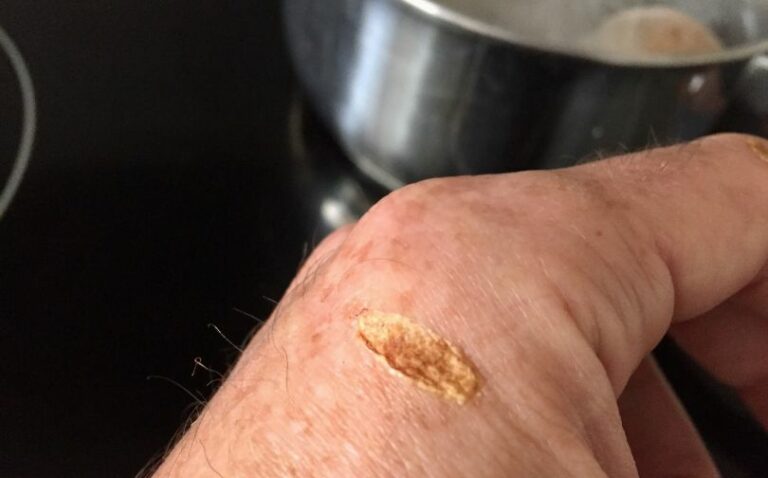 Kitchen First Aid Tips: Burn Treatment (Updated for 2024)