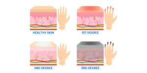 First Aid for Frostbite - Protect Yourself!