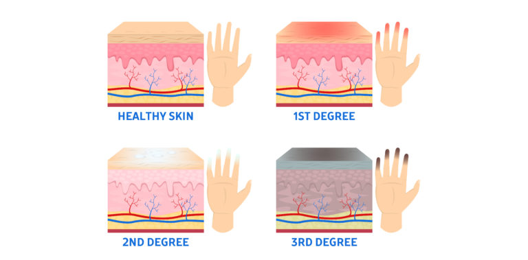 First Aid for Frostbite - Protect Yourself!