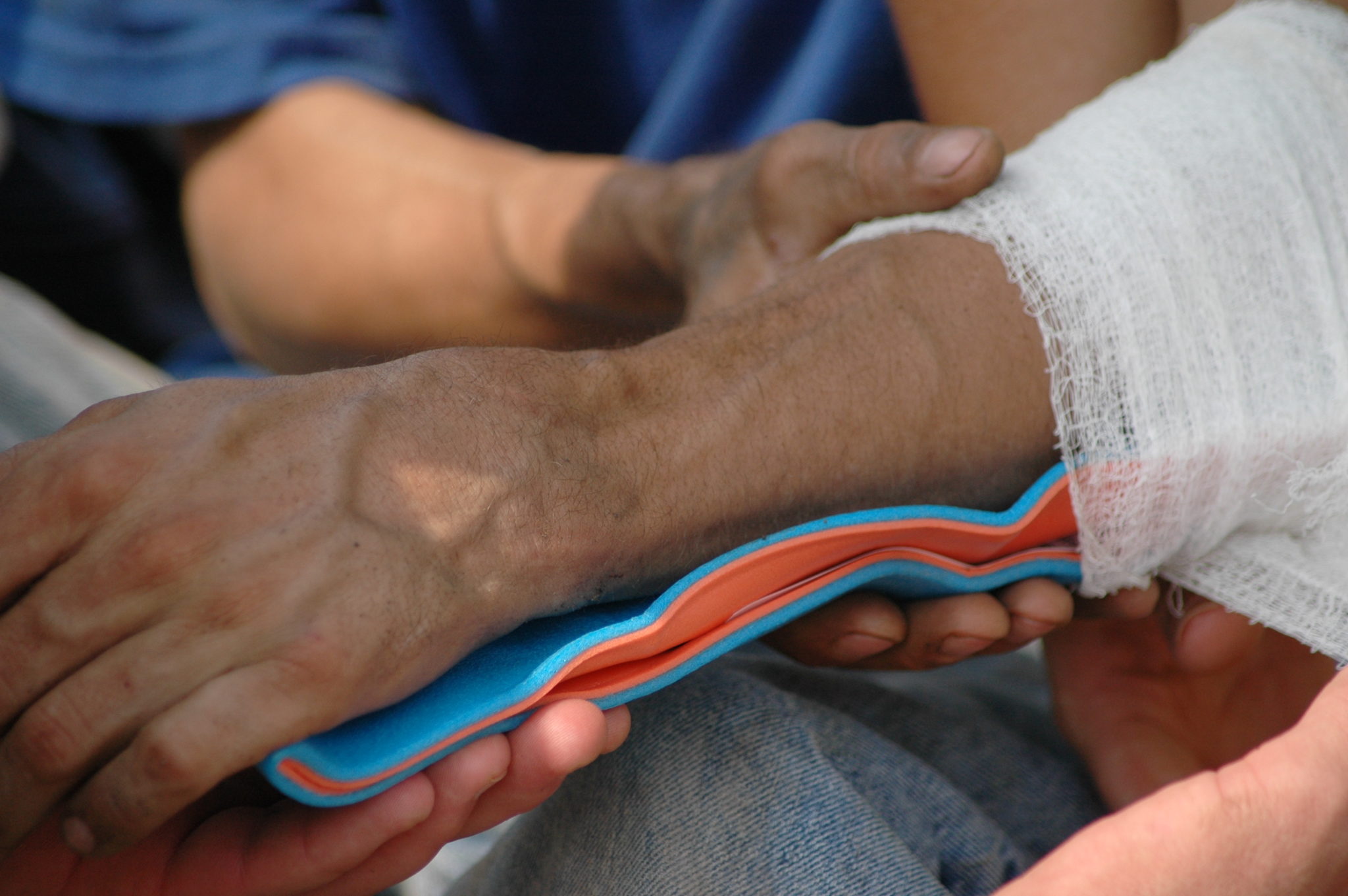 First Aid for a Broken Bone and Fractures - Essential Steps!