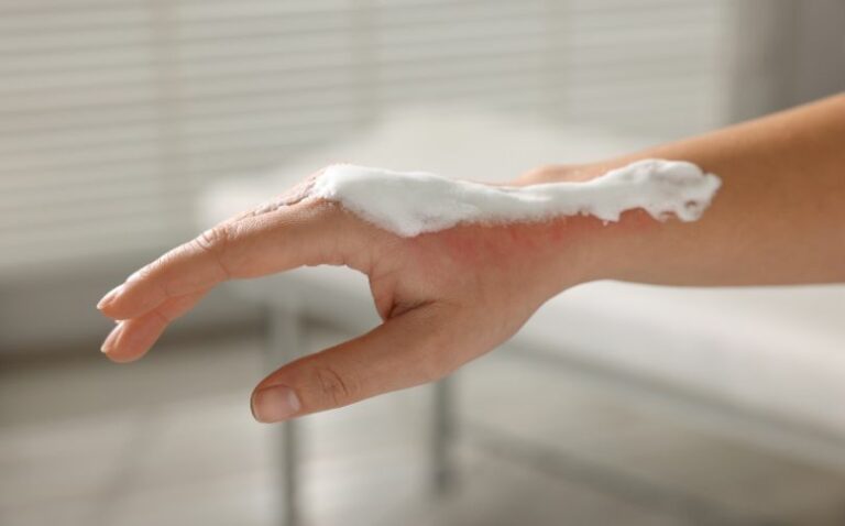 First Aid for Chemical Burns - Immediate Actions!