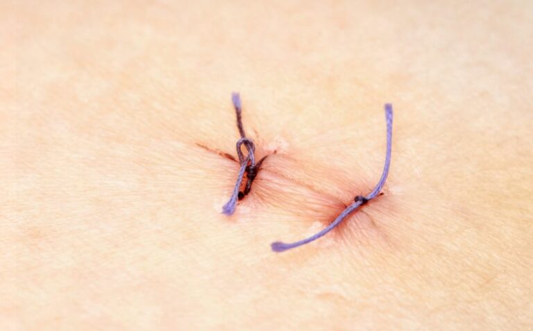 Surgical Staples vs Stitches - Pros and Cons!