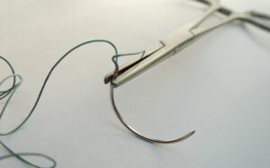 Surgical Staples vs Stitches - Pros and Cons!