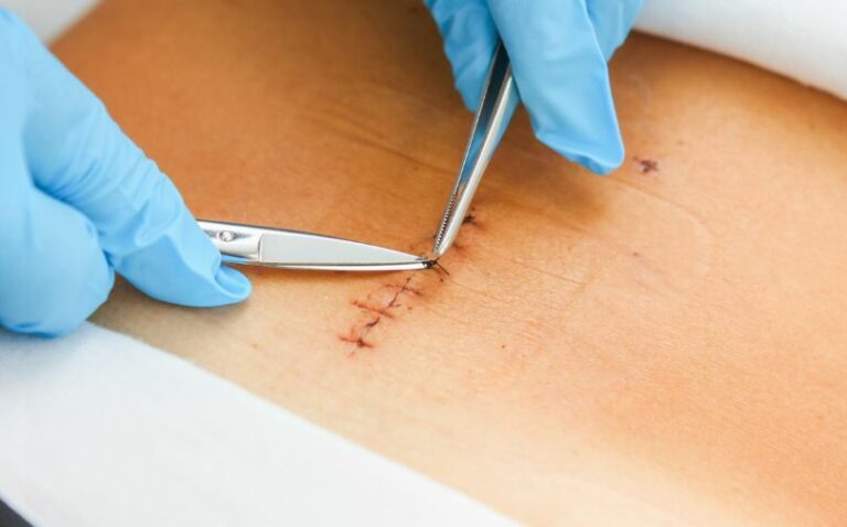 Surgical Staples vs Stitches - Pros and Cons!