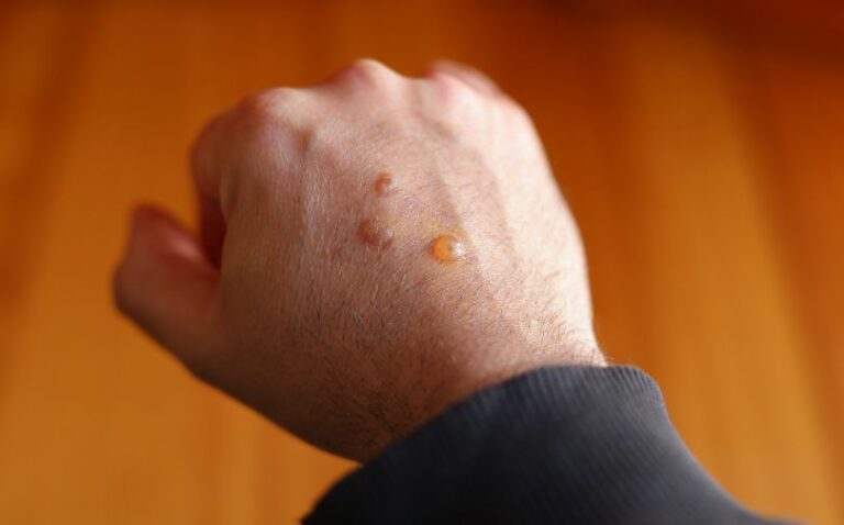 How to Treat Blisters - Quick Relief!