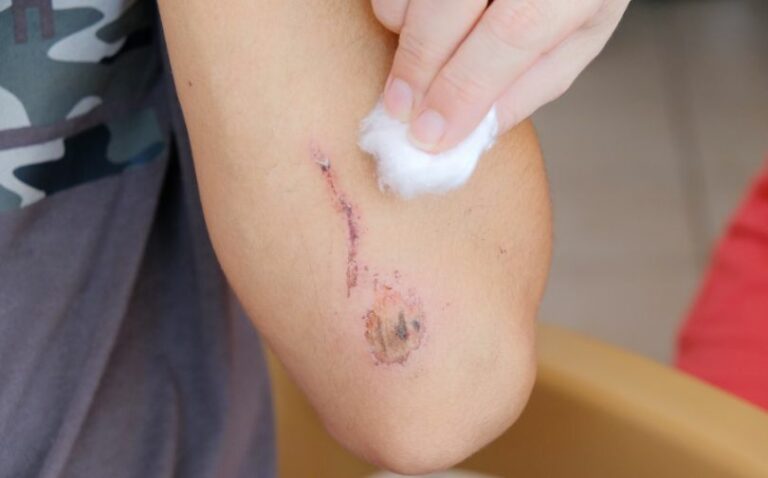 How Can You Tell If A Wound Is Infected Or Healing? What To Look For