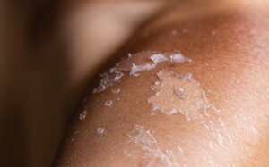 Why Does Sunburned Skin Peel? - Discover the Science!