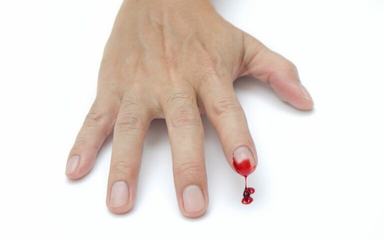 Slam Your Fingers In A Door? Here's What To Do Next!