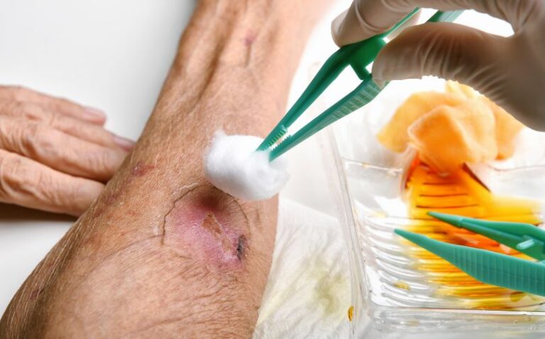 A Guide to Various Types of Open Wounds: Care Tips