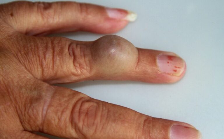 Lumps In Palm Of The Hand: Causes and Concerns