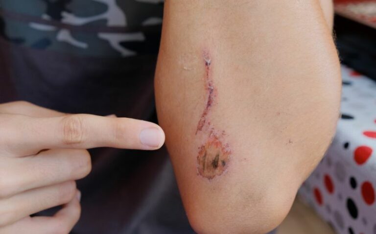 Lacerations vs. Abrasions: Key Differences Explained