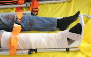 How to Use a SAM Splint: Essential Steps Explained